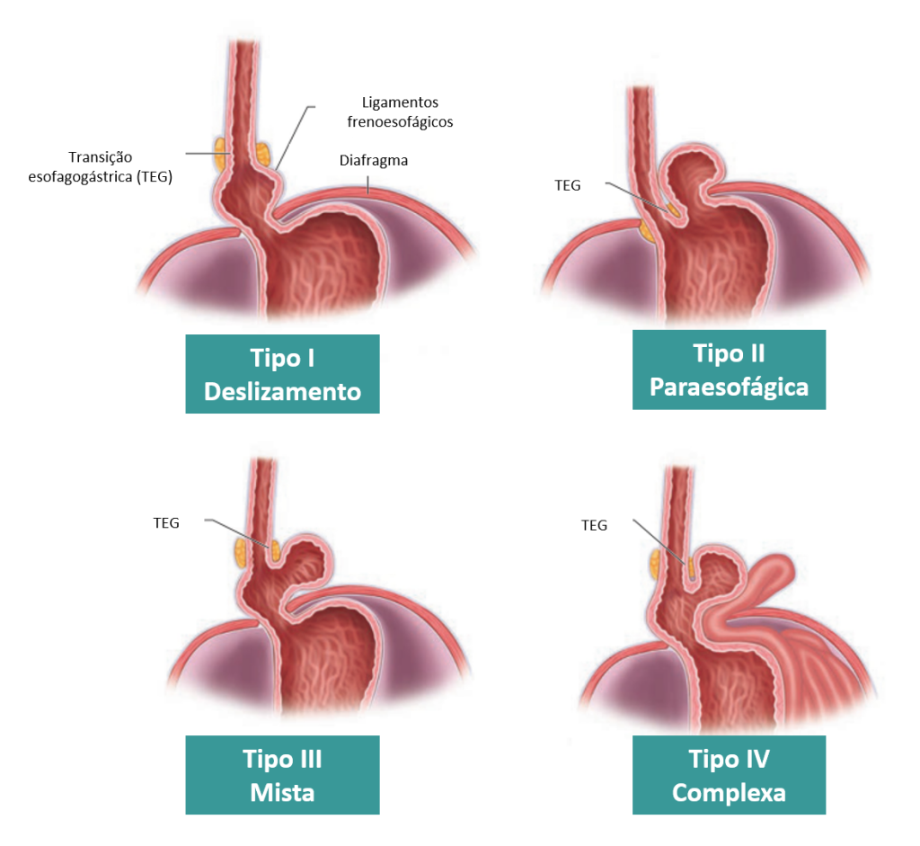Hérnia de Hiato: O que é? Quando operar? - Fabio Israel